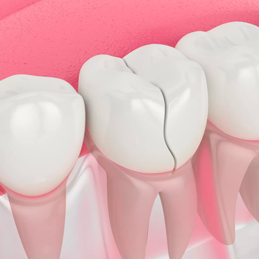 Tooth Extractions - Advanced Family Dentistry