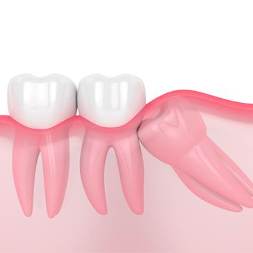 Tooth Extractions - Advanced Family Dentistry